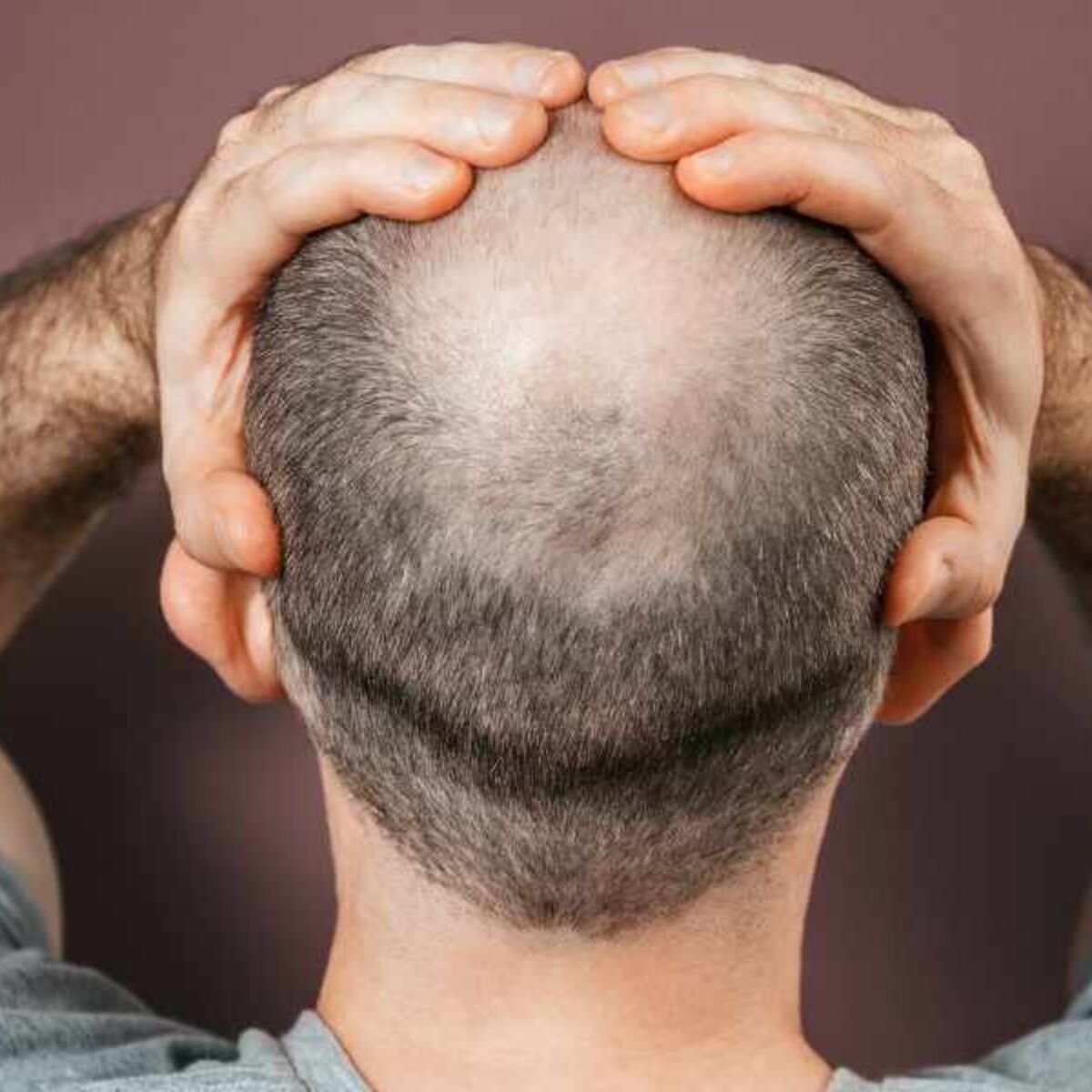 Perte de cheveux Homme – Clinique Spa Expert Capillaire